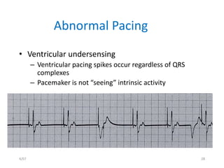Temporary pacemaker toufiqur rahman | PPT