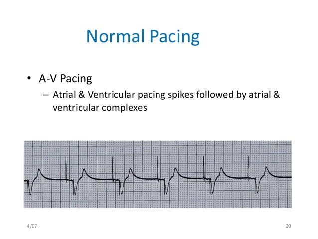 Temporary pacemaker toufiqur rahman