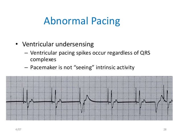 Temporary pacemaker toufiqur rahman
