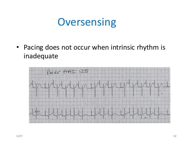 Temporary pacemaker toufiqur rahman