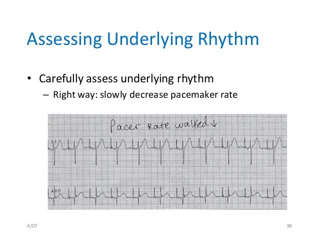 Temporary pacemaker toufiqur rahman