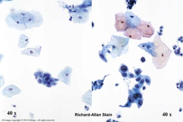 Thin prep morphology (Cervical cytology) | PPT