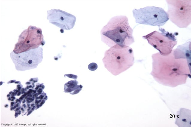 Thin prep morphology (Cervical cytology) | PPT