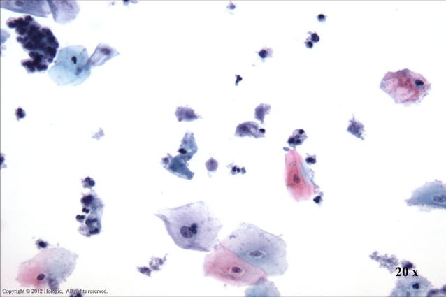 Thin prep morphology (Cervical cytology) | PPT