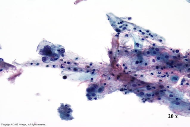 Thin prep morphology (Cervical cytology) | PPT