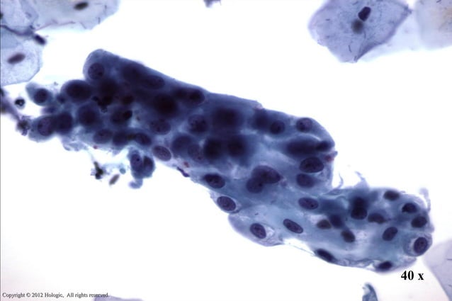 Thin prep morphology (Cervical cytology) | PPT