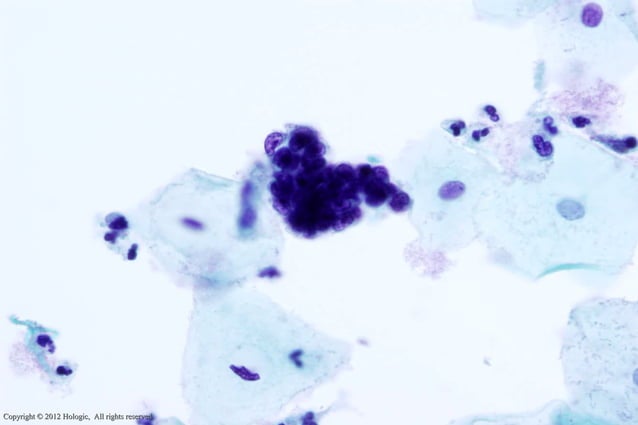 Thin prep morphology (Cervical cytology) | PPT