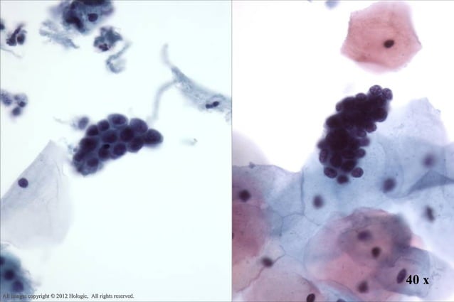 Thin prep morphology (Cervical cytology) | PPT