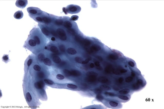 Thin prep morphology (Cervical cytology) | PPT