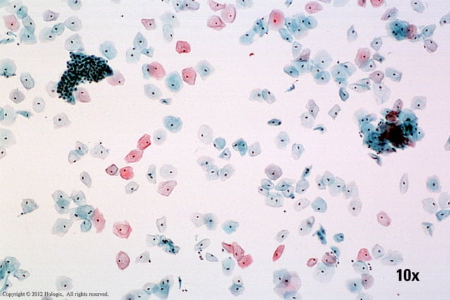 Thin prep morphology (Cervical cytology) | PPT