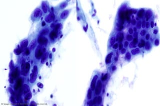 Thin prep morphology (Cervical cytology) | PPT