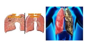 TPT (Terapi Pencegahan TBC).pptx