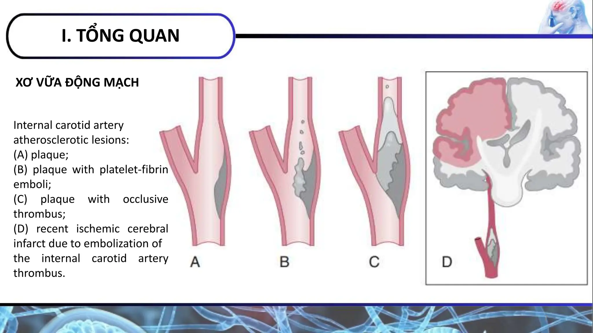 ĐỘT QUỴ - BSCKII. NGÔ THỊ KIM TRINH.pptx