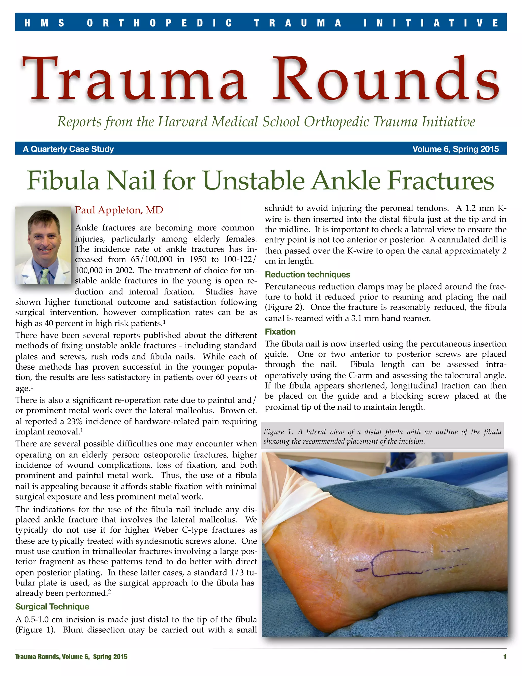 Fibula Nail for Unstable Ankle Fractures | PDF