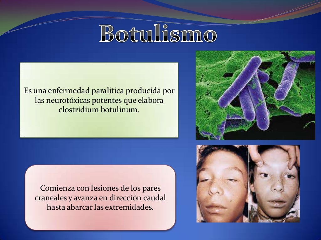 Botulismo. patología infecciosa. UCATECI.