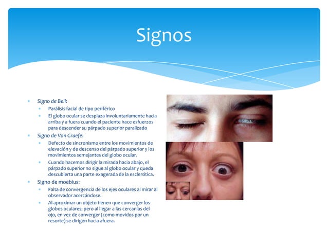 Endocrinología(Bocio Endémico,Graves Basedow,signos: Bell,Von Graefe ...