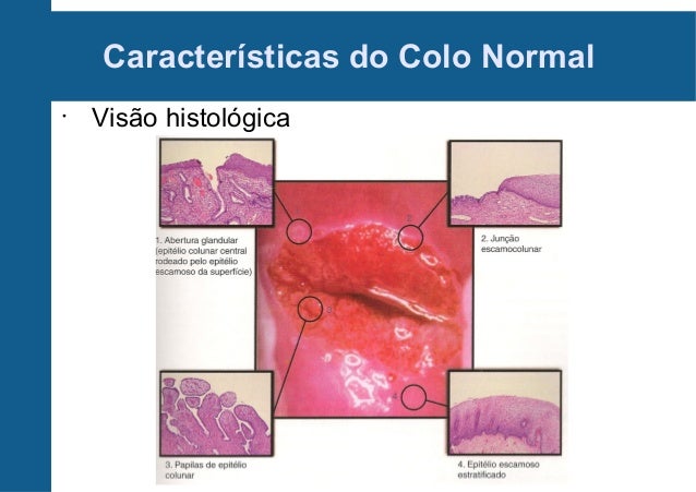 Trabalho colposcopia final