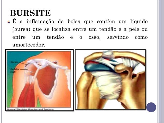 Apresentação de bursite pdf