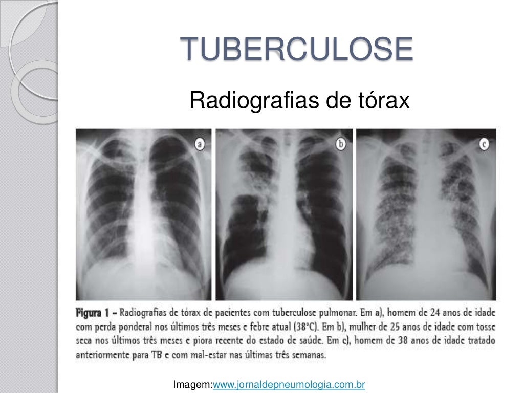 Tuberculose, Bronquiectasia e Doença de Crohn (Trabalho de Radiologia)