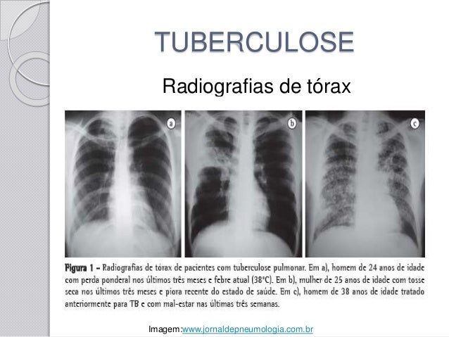 Tuberculose, Bronquiectasia e Doença de Crohn (Trabalho de Radiologia)