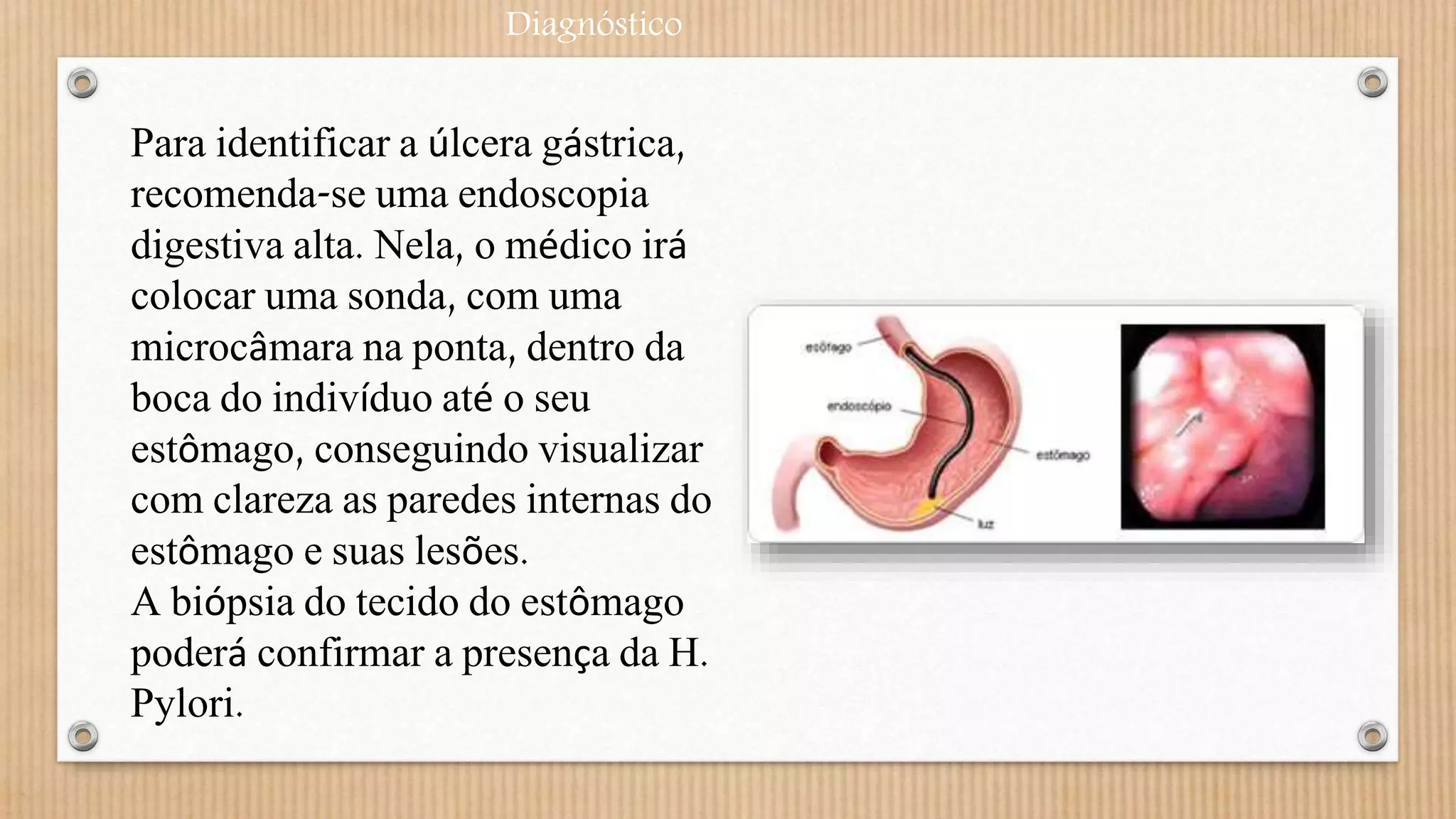 Úlcera Gástrica | PPTX