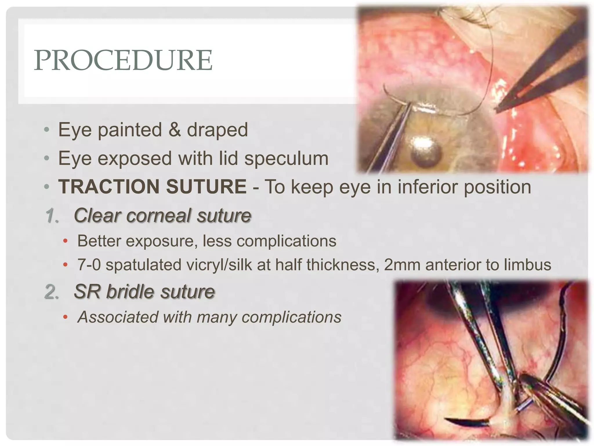 Trabeculectomy | PPTX