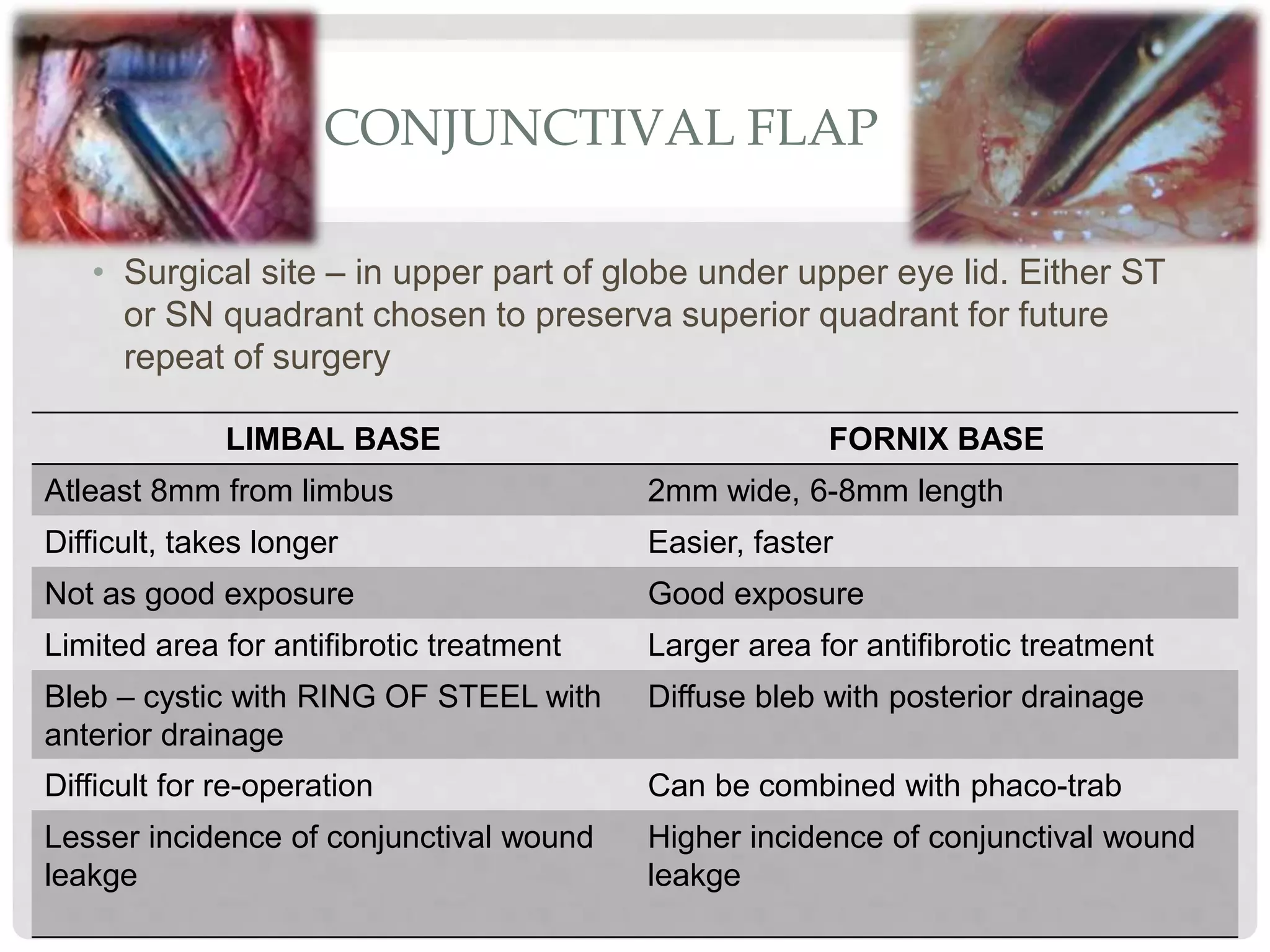 Trabeculectomy | PPTX
