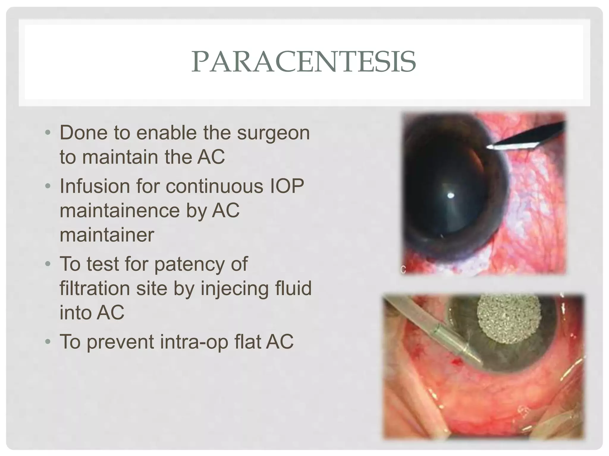 Trabeculectomy | PPTX