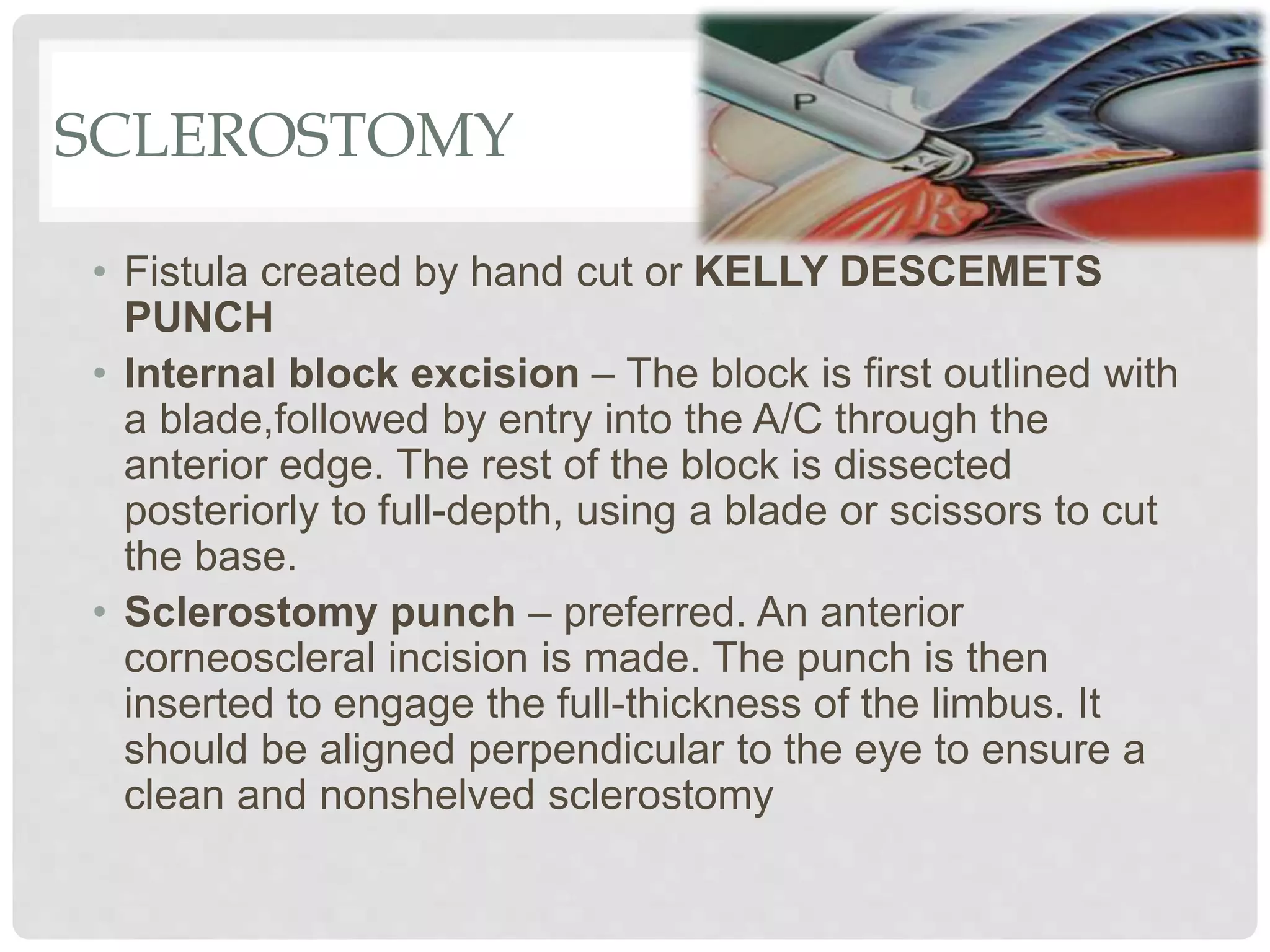Trabeculectomy | PPTX