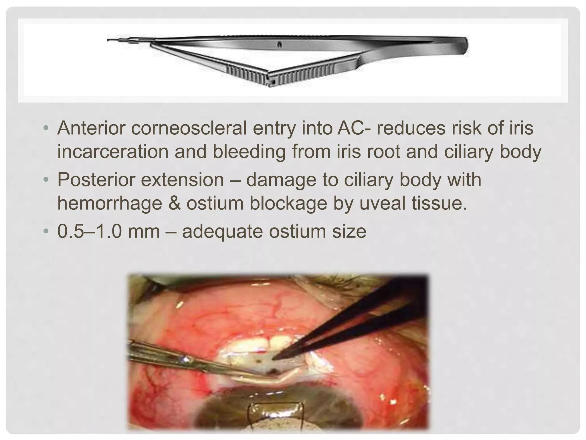 Trabeculectomy | PPTX