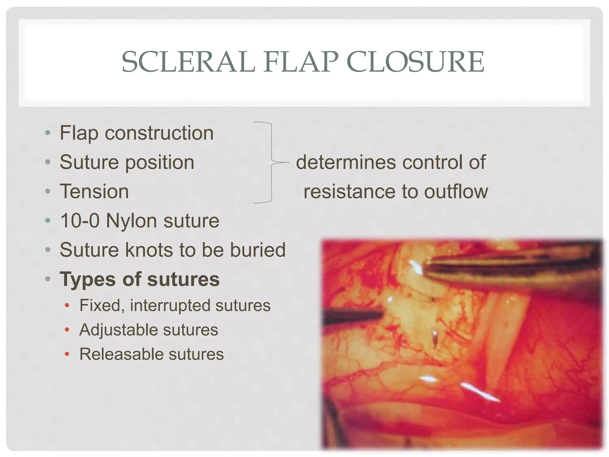 Trabeculectomy | PPTX