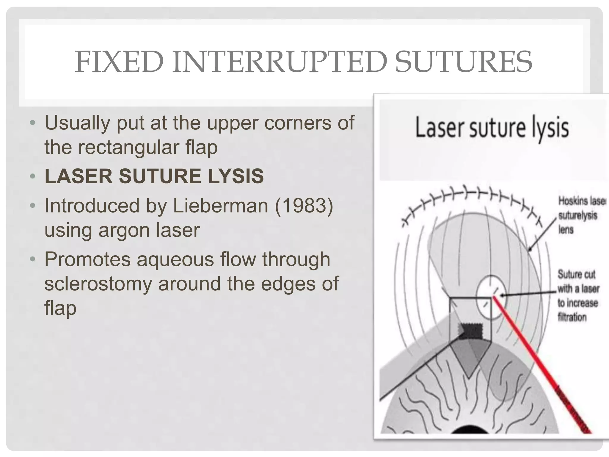 Trabeculectomy | PPTX