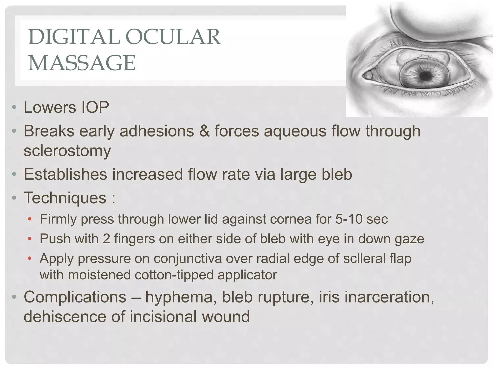 Trabeculectomy | PPTX