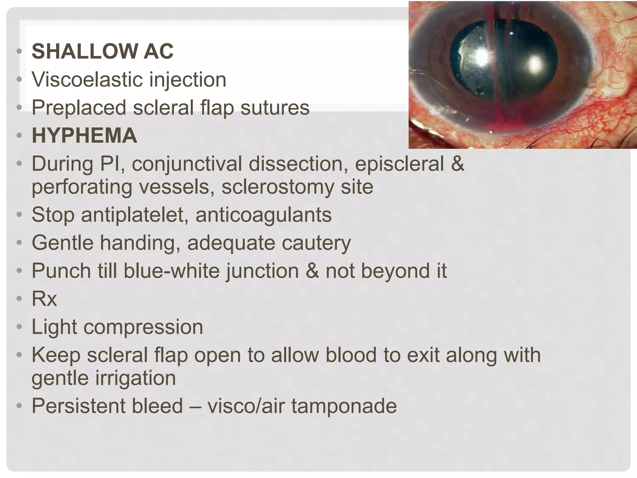 Trabeculectomy | PPTX