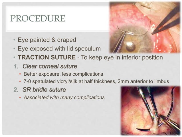 Trabeculectomy | PPTX