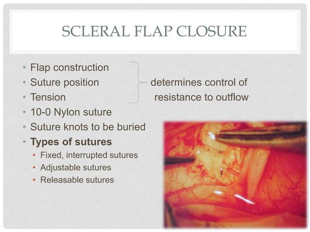 Trabeculectomy | PPTX