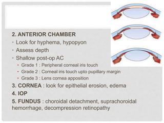 Trabeculectomy | PPTX