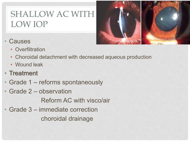 Trabeculectomy | PPTX