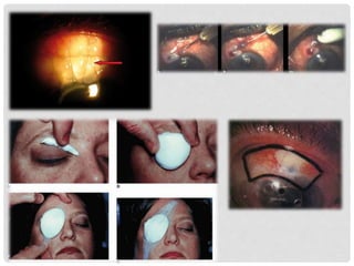 Trabeculectomy | PPTX