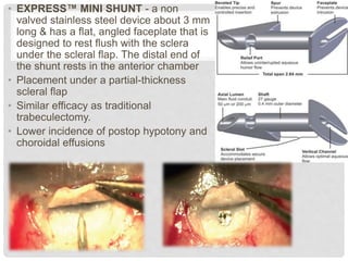 Trabeculectomy | PPTX