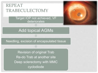 Trabeculectomy | PPTX