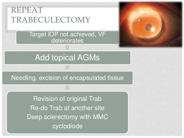 Trabeculectomy