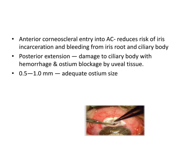 Trabeculectomy.pptx