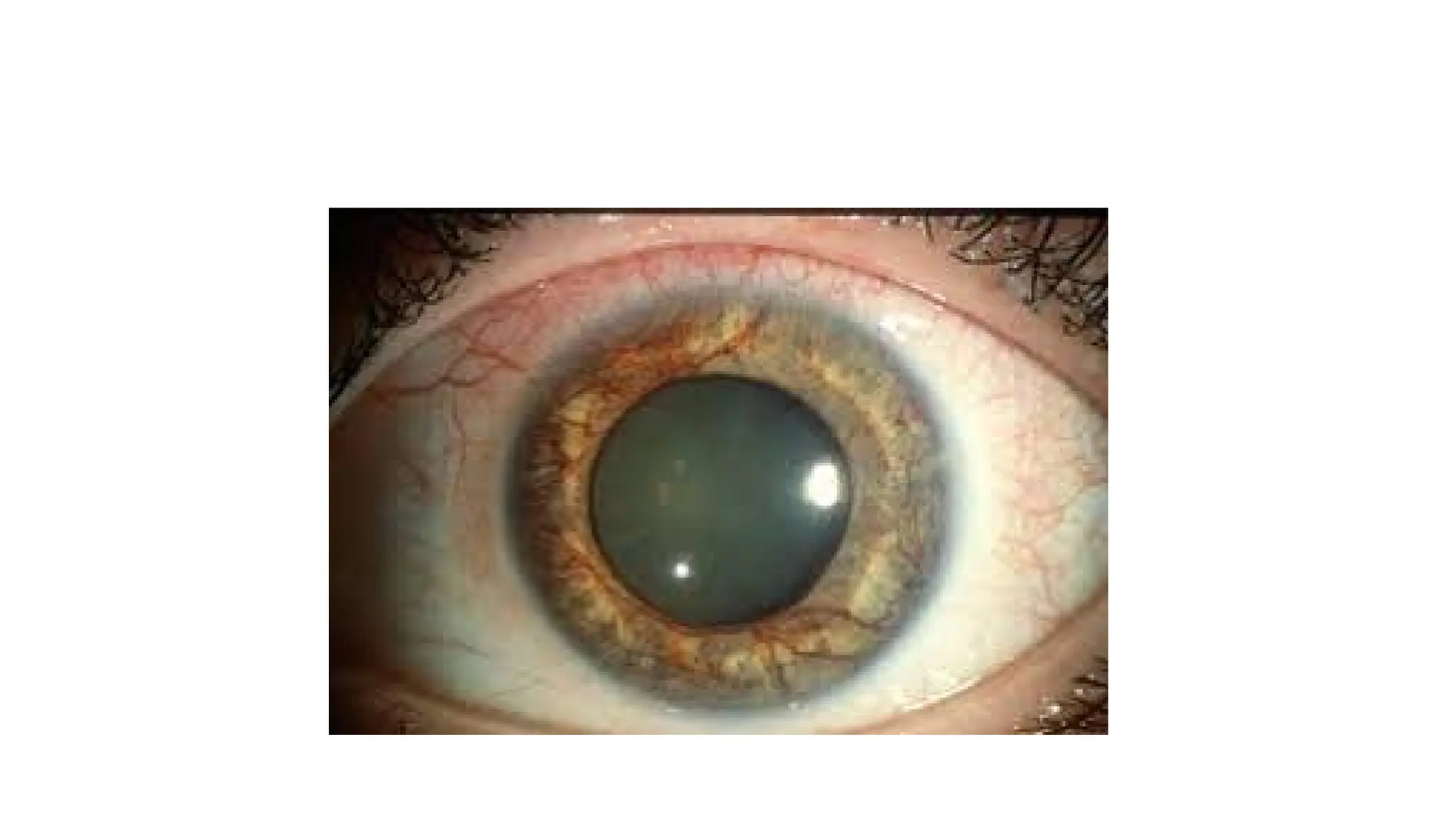 Trabeculectomy pearls for ophthalmologists.pptx