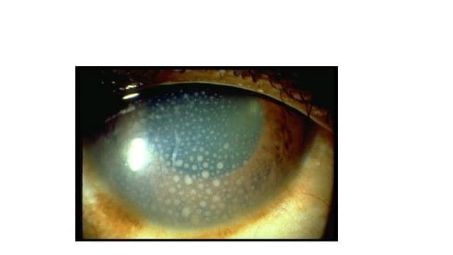 Trabeculectomy pearls for ophthalmologists.pptx