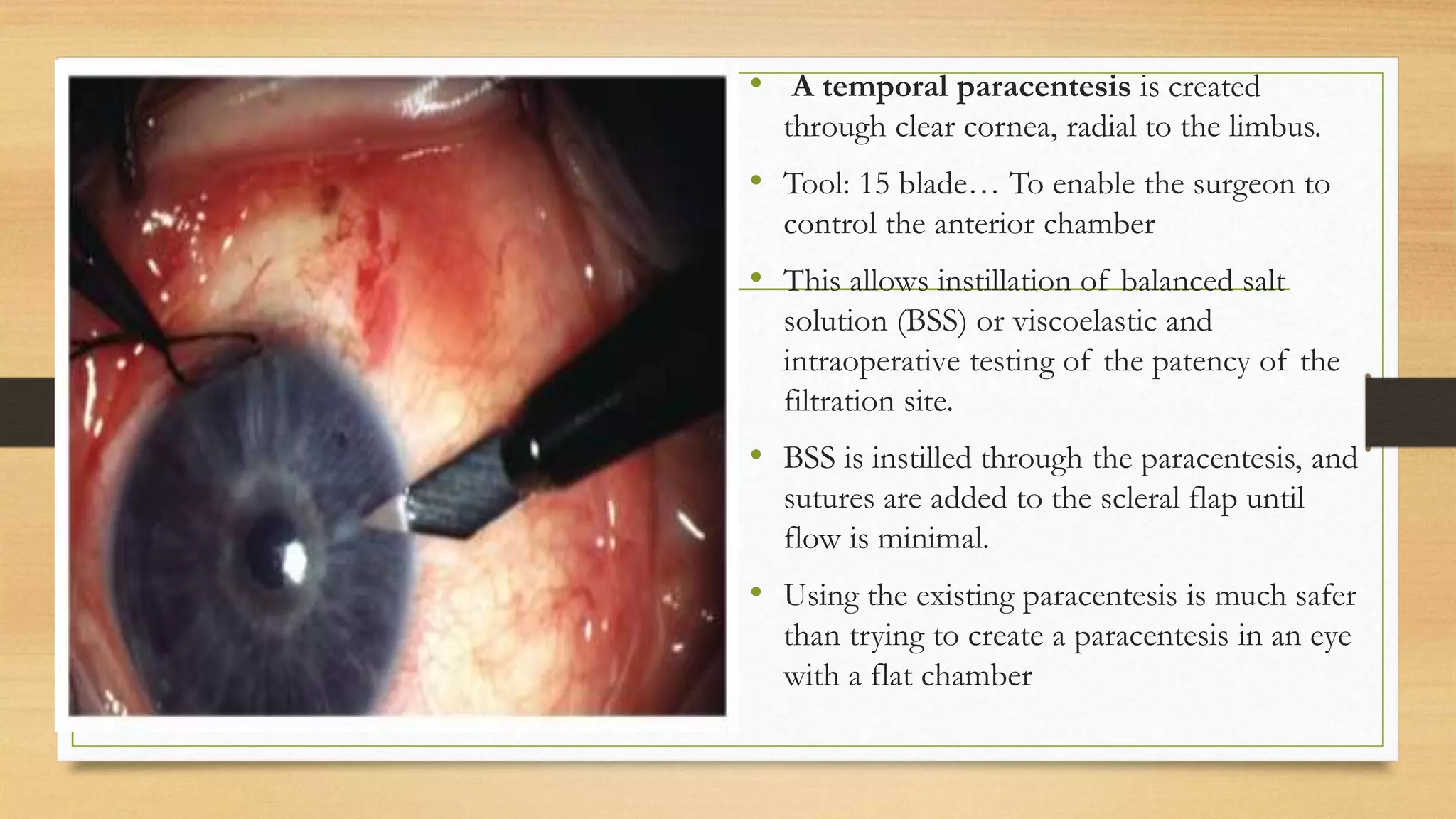 Trabeculectomy surgical procedure | PPTX