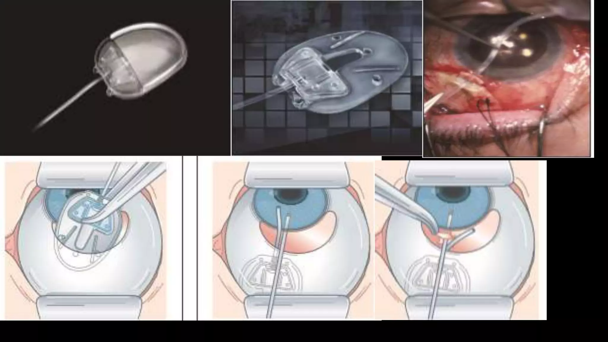 Trabeculectomy surgical procedure | PPTX