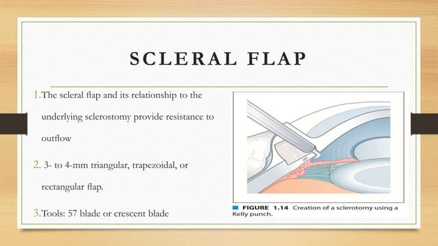 Trabeculectomy surgical procedure | PPTX