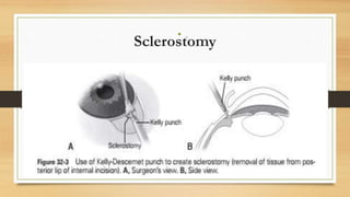 Trabeculectomy surgical procedure | PPTX