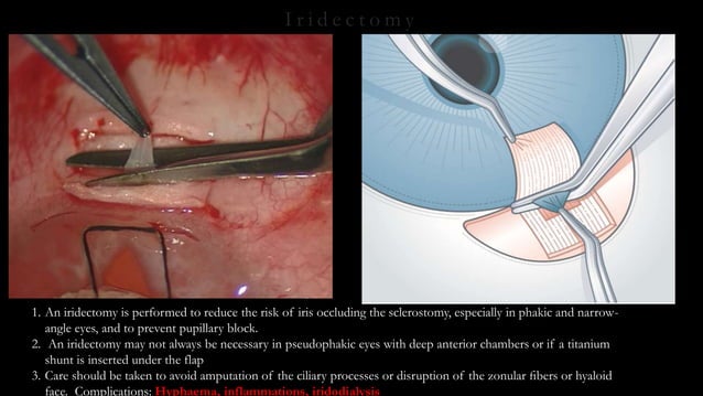 Trabeculectomy surgical procedure | PPTX